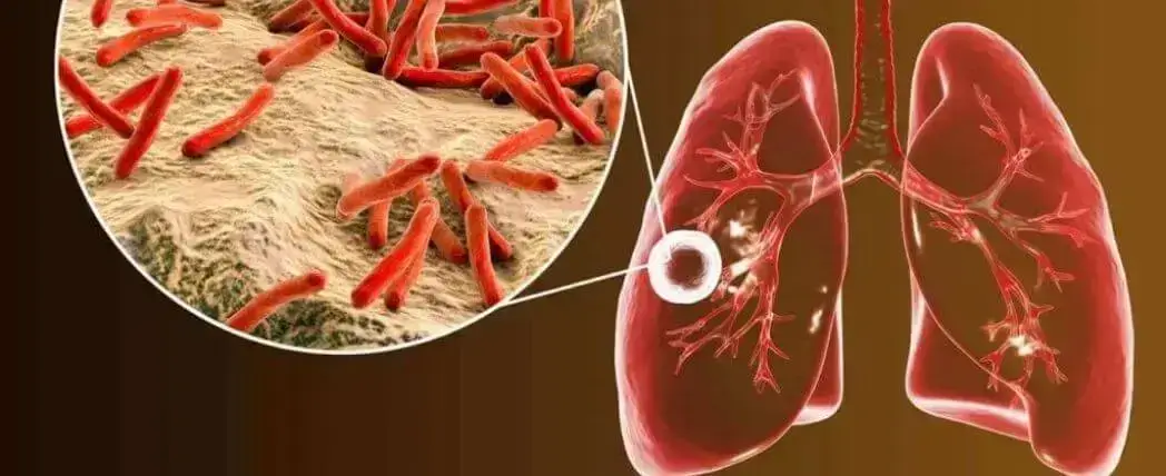 TB Test What Positive PPD And Negative PPD Results Mean Nao Medical